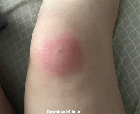 عکس جای نیش حشرات مختلف
