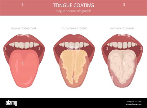 Tongue Coating Oral Medicine White Tongue Yellow Coated Tongue