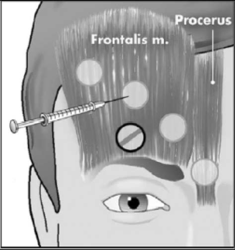 Anterior Injection Sites In Procerus And Frontalis Muscles Download Scientific Diagram