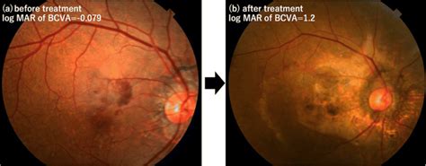 Color Fundus Photography Of A Representative Case Of Rpe Atrophy A At Download Scientific