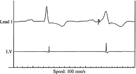 Surface Ecg Tracings And Lv Electrogram Recorded From A Patient With A