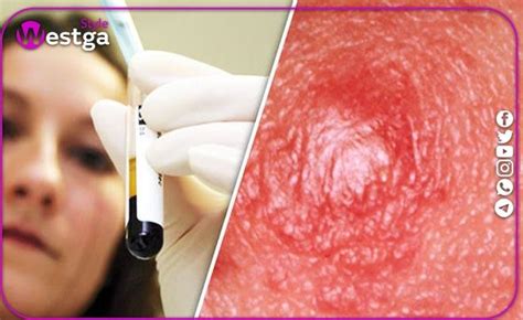 ئاگاداری ئهم نهخۆشییهبن لهڕێی سێكسهوه دهگوازرێتهوه