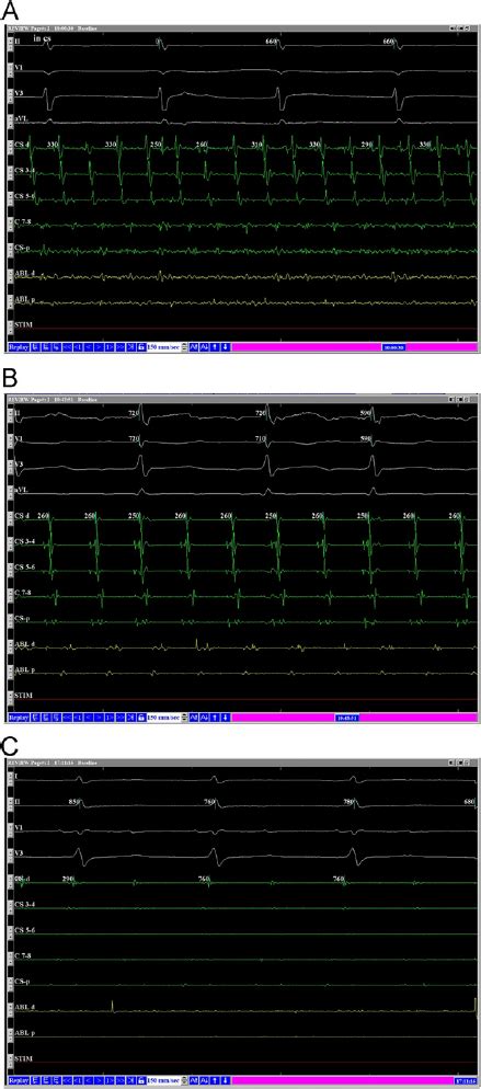 Complex Fractionated Atrial Electrograms Cfaes The Ablation Catheter Download Scientific