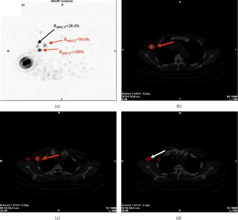 Value Of Quantitative Spectct Lymphoscintigraphy In Improving Sentinel Lymph Node Biopsy In