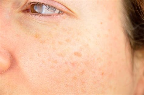 Causes Of Dry Patches On Face And Their Treatment Charlies Magazines