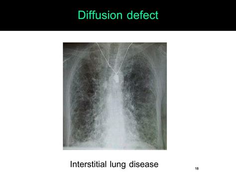 Ppt Arterial Blood Gas Interpretation Powerpoint Presentation Free