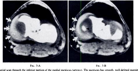 Figure 3 From Prediction Of The Angle Of Gibbus Deformity In