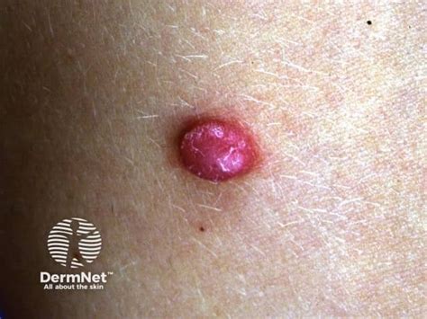 Histoquarterly Pyogenic Granuloma Histology Blog