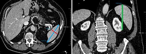 Spleen Volume Weight And Index Calculator Ct And Mri