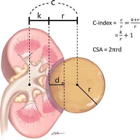 Geometric Interplay Between Renal Volume C Index And Csa R Tumor Download Scientific