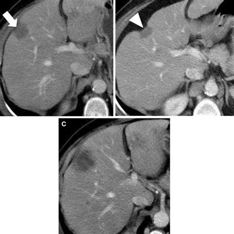 48 year old woman with hepatic metastases from colorectal download