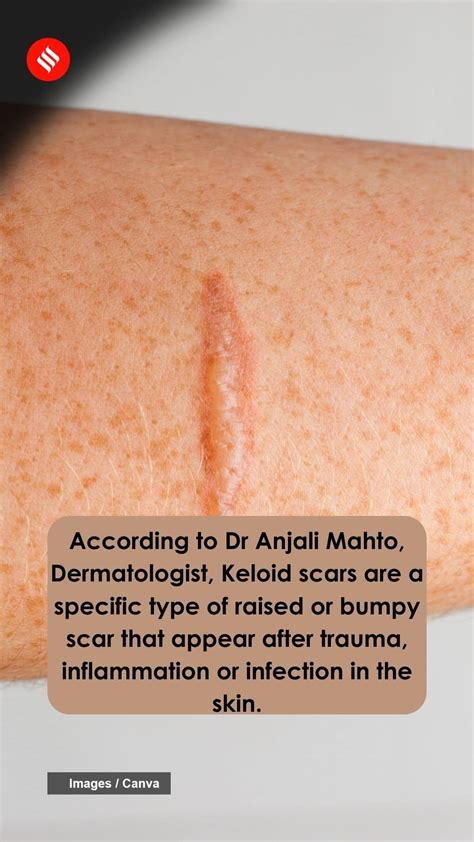 What Are Keloid Scars The Indian Express