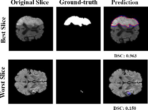Figure 2 From Deep Learning For Automated Ischemic Stroke Lesion Segmentation From Multi