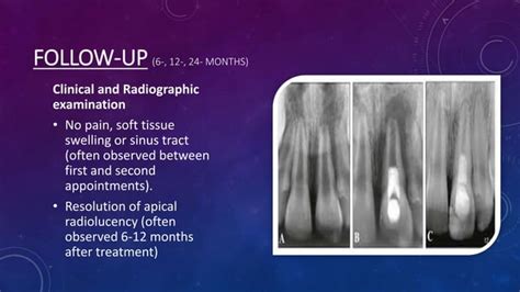 Pulp Revascularization Pptx