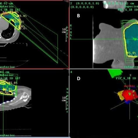 The Dose Volume Histogram DVH Of A Patient S Different Plans Download Scientific Diagram