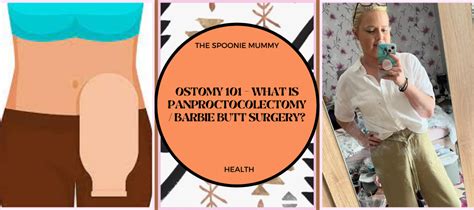 Ostomy 101 What Is Panproctocolectomy Barbie Butt Surgery The Spoonie Mummy