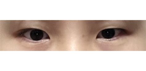 쌍꺼풀 절개 후기 리얼후기 눈이 예쁘다 그래서 아몬드성형외과