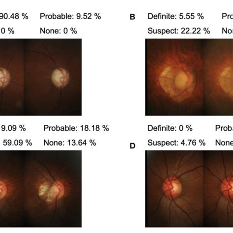 Optic Disc Examples At Virginia Lyman Blog