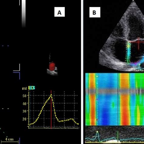 A Assessment Of Left Atrial Volume With 3d Atrial Volume Analysis B 2d Download Scientific