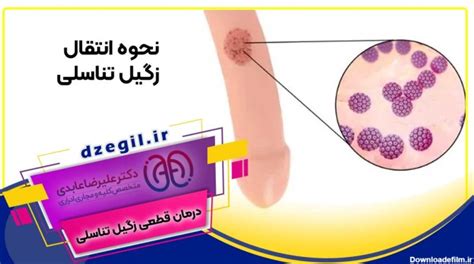 عکس زگیل تناسلی مقعدی در زنان