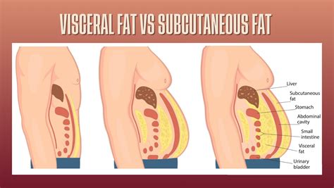 Subcutaneous Vs Visceral Fat Whats The Difference And What Can Be Done
