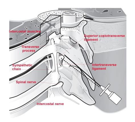 Thoracic Paravertebral Block Landmark Techniques Virtual Library