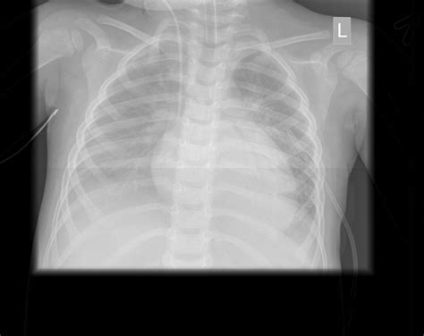 Chest X Ray 17 Diseases Classification Dataset By Ehealthia