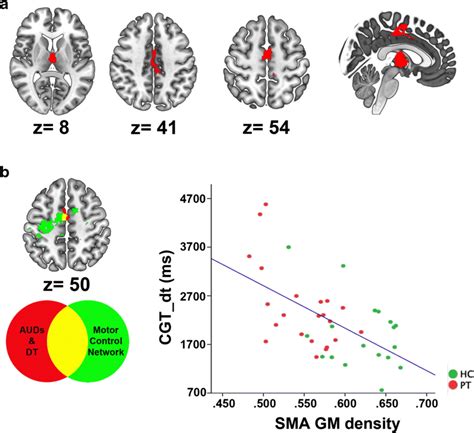 Slowed Decision Making And Gm Atrophy In The Motor Control Network The