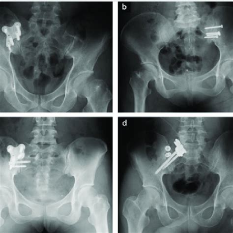 Pdf Pitfalls During Sacroiliac Joint Arthrodesis For Patients With Severe Sacroiliac Joint