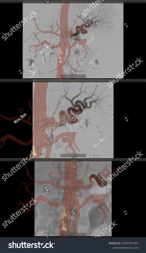 Aorta Angiogram Over 317 Royalty Free Licensable Stock Illustrations And Drawings Shutterstock