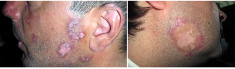 Discoid Cle In The Face Of Patients With No Systemic Symptoms Showing