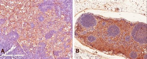 Immunohistochemical Analyses Demonstrated Absence Of Intact Islets Beta