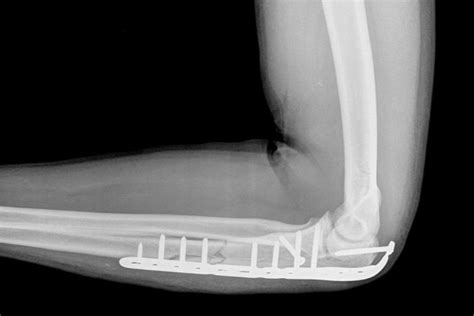 Exogen Exogen Wypożyczalnia Exogen Cena Humanus