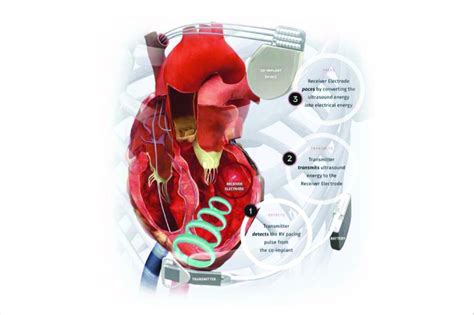 Components Of The WiSE CRT System Reproduced From Reference Download Scientific Diagram