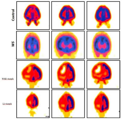 Single Photon Emission Computerized Tomography Spect Imaging The Use Download Scientific