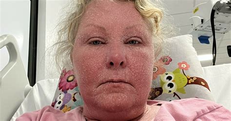 Topical Steroid Withdrawal This Should Never Have Been Done