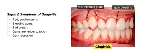 Is Gingivitis Contagious Can You Get Gum Disease By Kissing Share