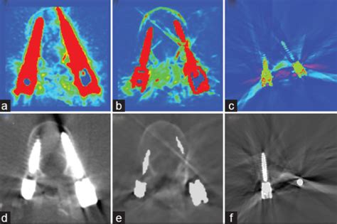 Reduction Of Metal Artifacts Caused By Titanium Peduncular Screws In