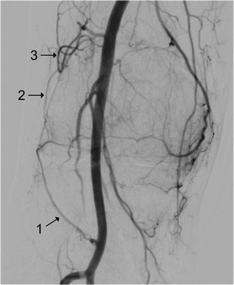 Genicular Artery Embolization A Review Of Essential Anatomic
