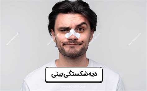 دیه شکستگی بینی در سال ۱۴۰۴ مجازات شکستن بینی در دعوا