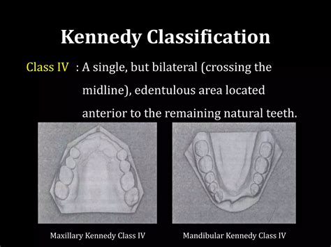 Dental Classification For Removable Partial Denture Ppt