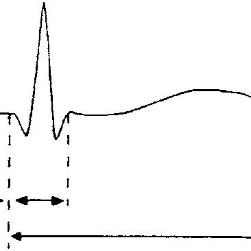 Schematic Electrocardiographic Trace Showing The QT Interval Download Scientific Diagram