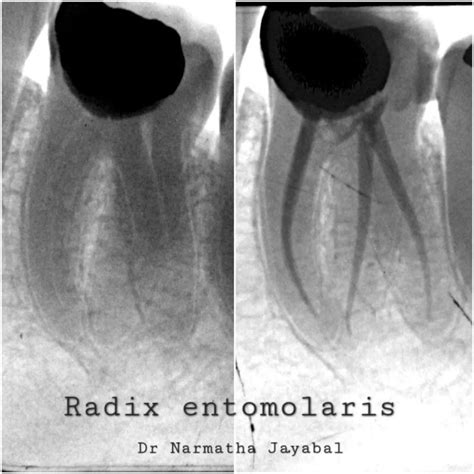 Dr Narmatha Jayabal On Linkedin Radix Radixentomolaris