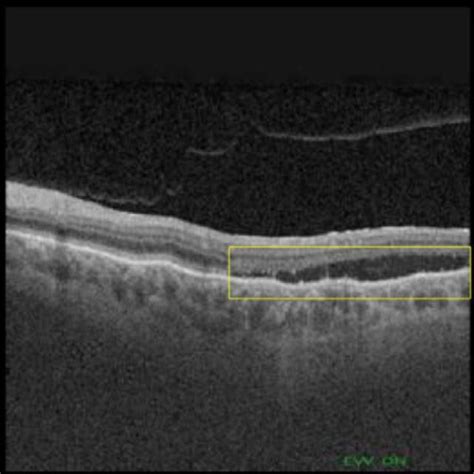 Oct Image Showing Subretinal Fluid Associated With Amd Surrounded By A