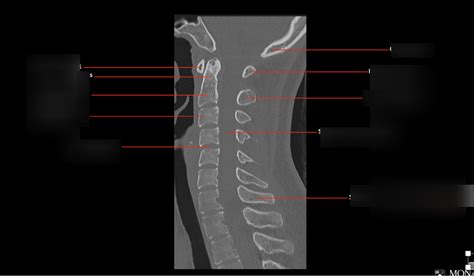 Diagram Of Sagittal Cross Section Of Ct Spine Quizlet