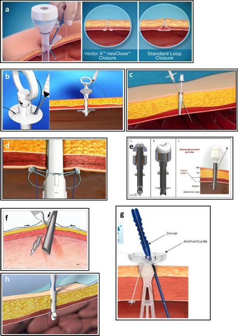 Representative Selection Of Laparoscopic Instruments And Closure