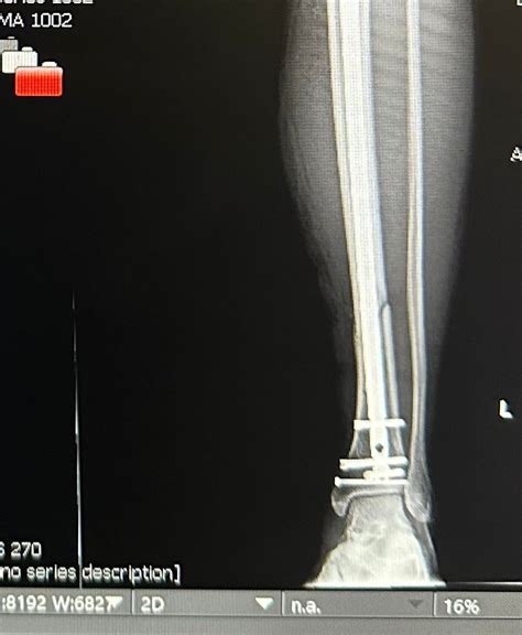 Broken Tibia R Brokenbones