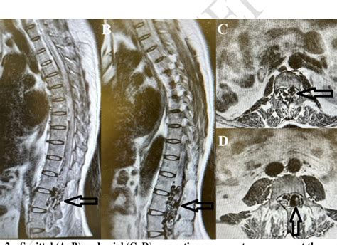 Non Contrast Axial A B And Sagittal C Tomograms The Subarachnoid