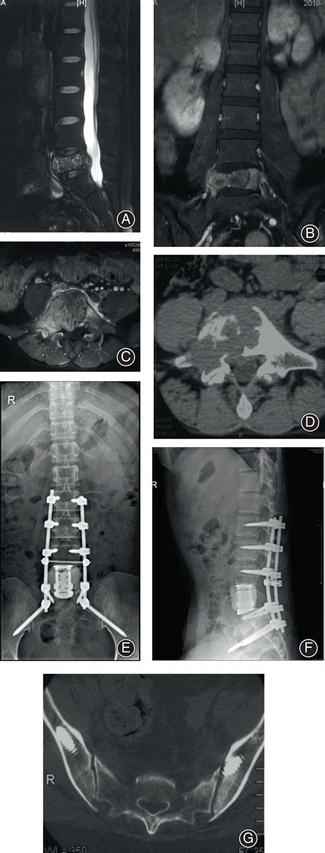 Case 15 Giant Cell Tumor Of Bone At L5 In A 30 Year Old Woman A Download Scientific Diagram