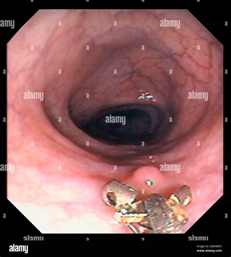 Polyp Removal Endoscope View Of A Polyp Being Removed From The Lining Of The Colon Forceps On